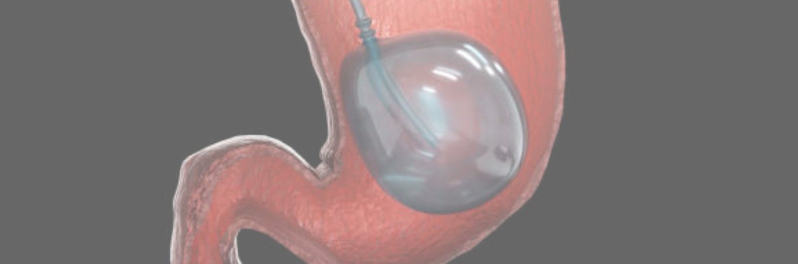 Balón Intragástrico | Dr. Edgar de León